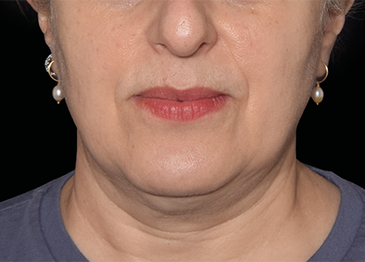 Emface - Less Wrinkles More Lift