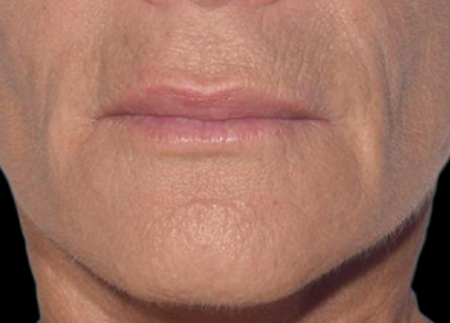 Exion - The Ultimate Skin Solution