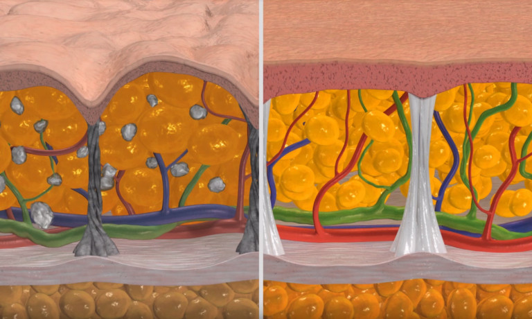 Emtone - non-invasive cellulite reduction and overall improvement of skin